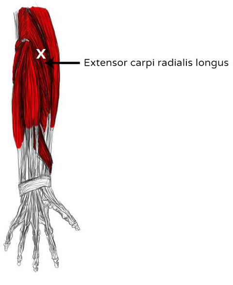 Extensor carpi radialis longus pain & trigger points