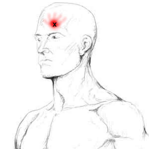 Frontalis and Occipitalis – Pain & Trigger Points