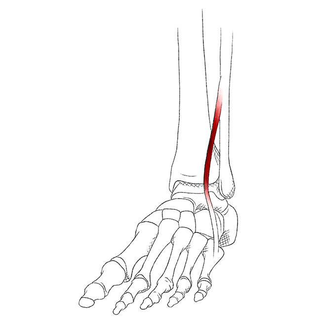 Peroneus Longus, Brevis and Tertius – Pain & Trigger Points