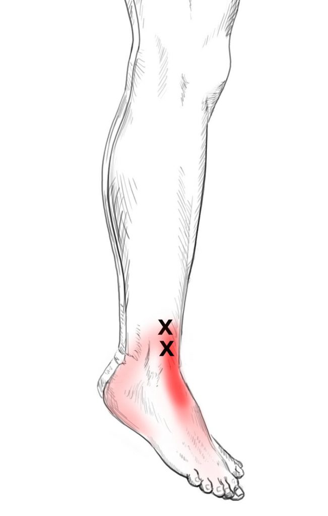 Peroneus Longus, Brevis and Tertius – Pain & Trigger Points