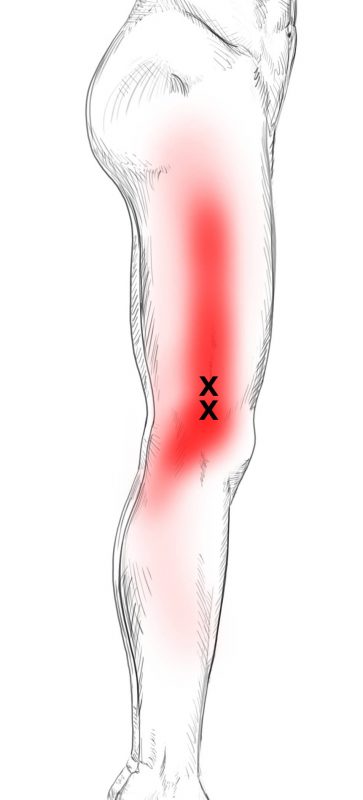 Vasto Lateral