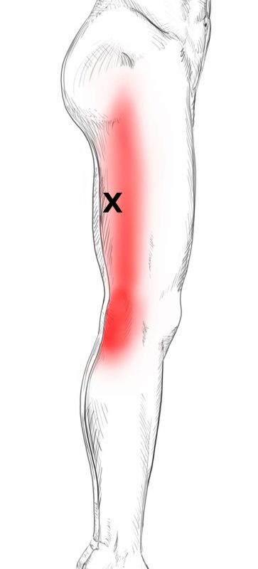 Quadriceps Femoris – Pain & Trigger Points