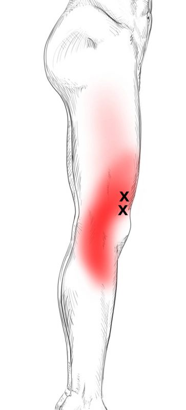 Vastus Lateralis Pain