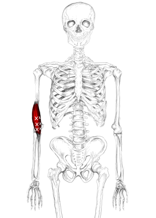 Brachialis muscle pain & trigger points