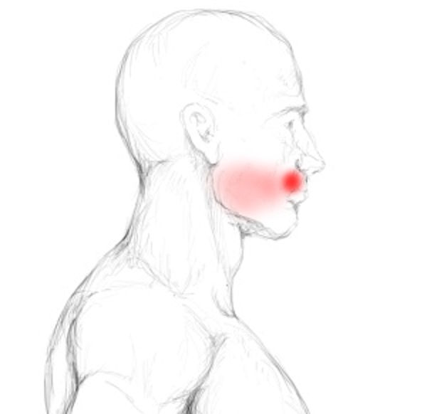 Buccinator – Pain & Trigger Points