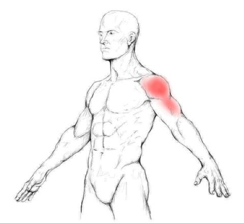 Deltoid muscle pain & trigger points