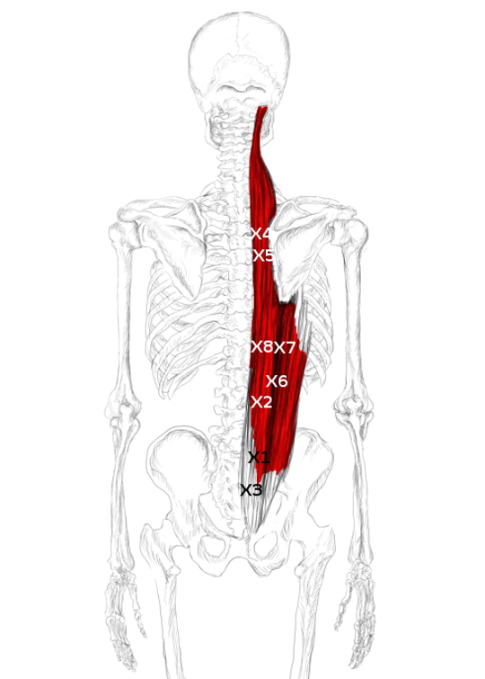 Erector spinae muscle pain & trigger points
