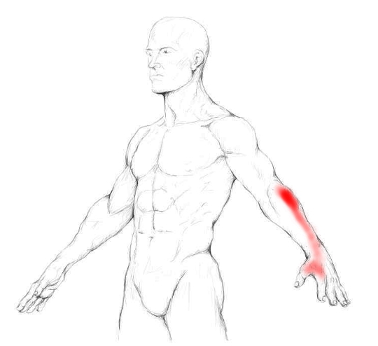 Extensor carpi radialis longus pain & trigger points