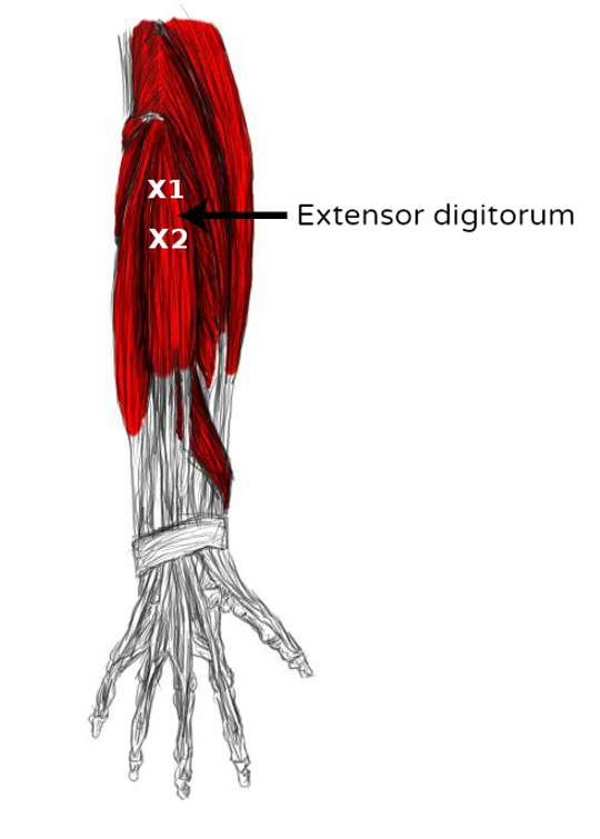 Extensor digitorum muscle pain & trigger points
