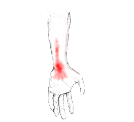 Flexor carpi radialis pain & trigger points