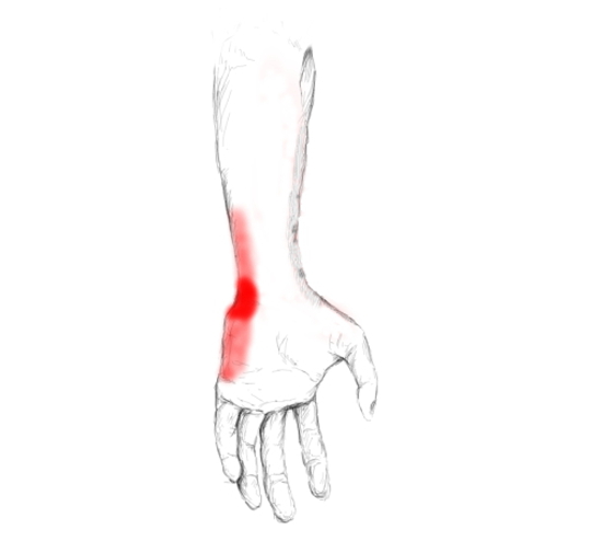 Flexor carpi ulnaris pain & trigger points