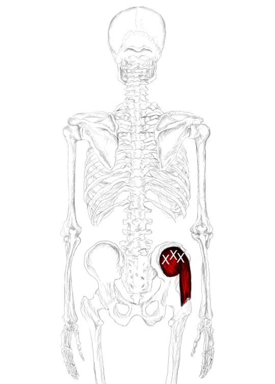 Gluteus medius muscle pain & trigger points