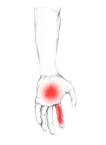 Interossei, Lumbricales & Abductor digiti: Pain & Trigger Points