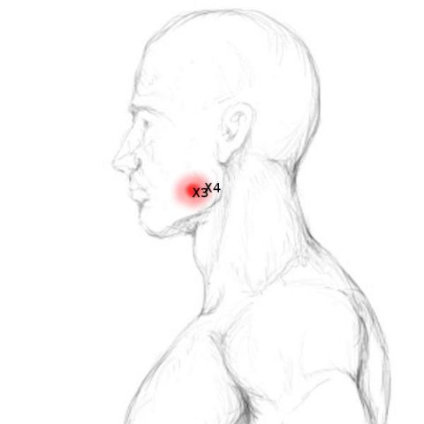 Masseter – Pain & Trigger Points