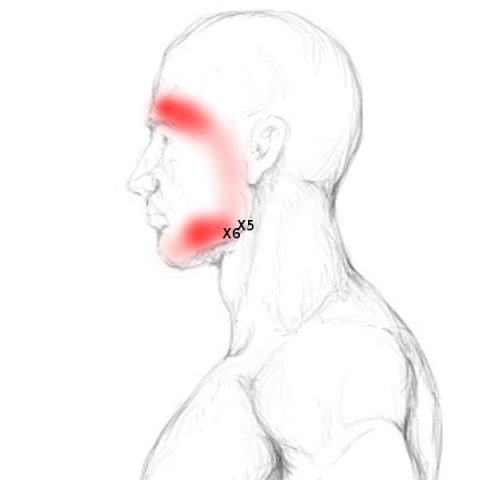 Masseter – Pain & Trigger Points