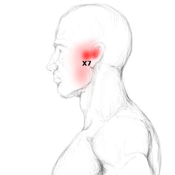 Masseter – Pain & Trigger Points