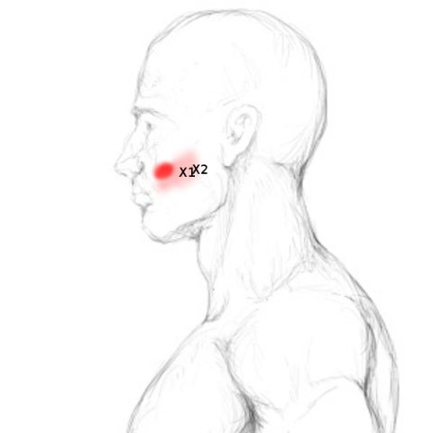 Masseter – Pain & Trigger Points