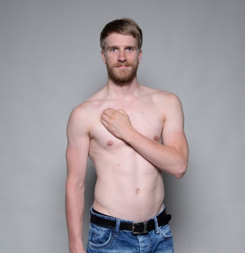 Pectoralis minor pain & trigger points