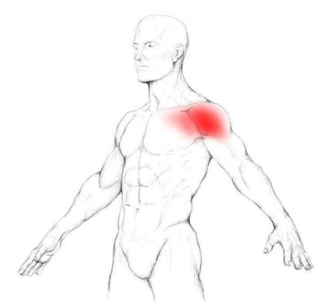 Pectoralis major muscle pain & trigger points