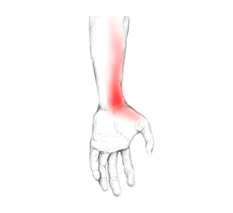 Pronator teres pain & trigger points