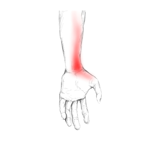 Pronator teres pain & trigger points