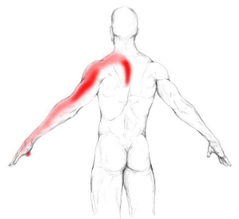 Pain Scalene Trigger Point Points Referred Muscle Muscles Shoulder Arm ...