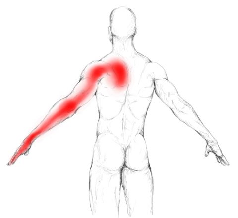 Serratus Posterior Superior Trigger Point Ep 328 The Serratus