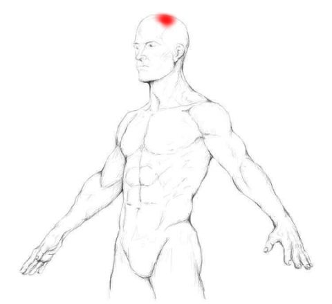 Splenius capitis & cervicis pain & trigger points
