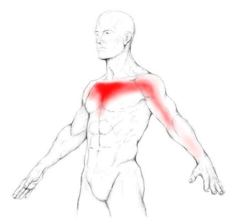 Sternalis pain & trigger points