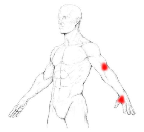 Supinator pain & trigger points