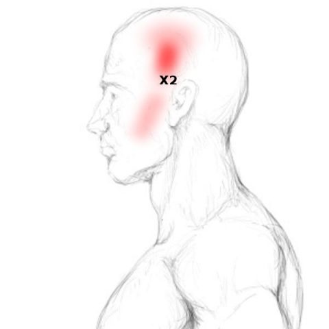 Temporalis – Pain & Trigger Points