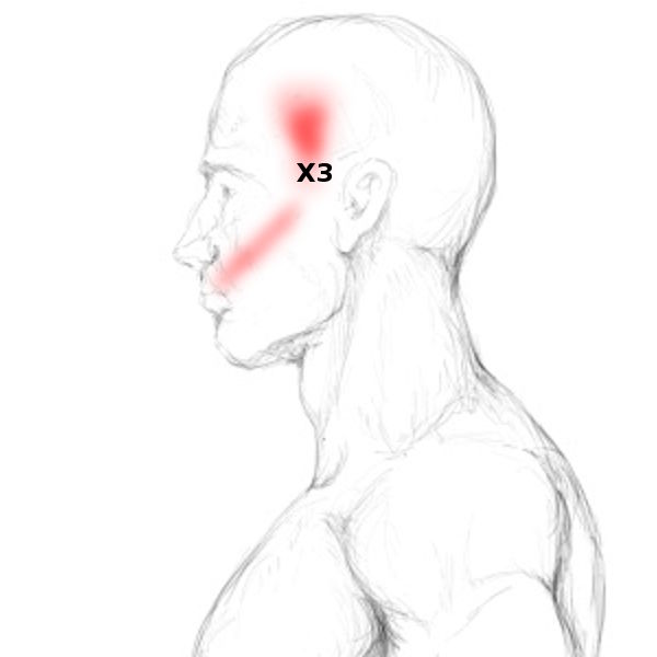 Temporalis – Pain & Trigger Points