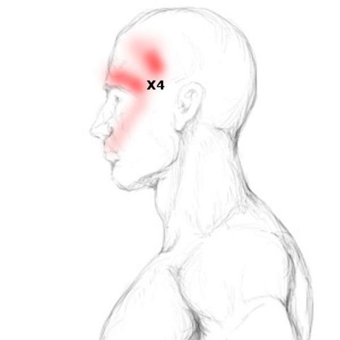 Temporalis – Pain & Trigger Points