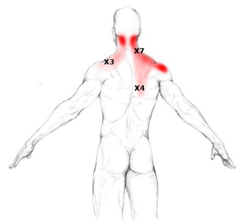 Trapezius Trigger Points
